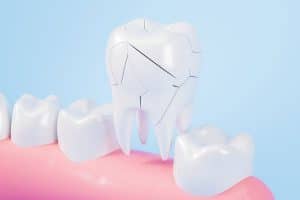 5 Signs You Cracked a Tooth – Modern Micro Endodontics