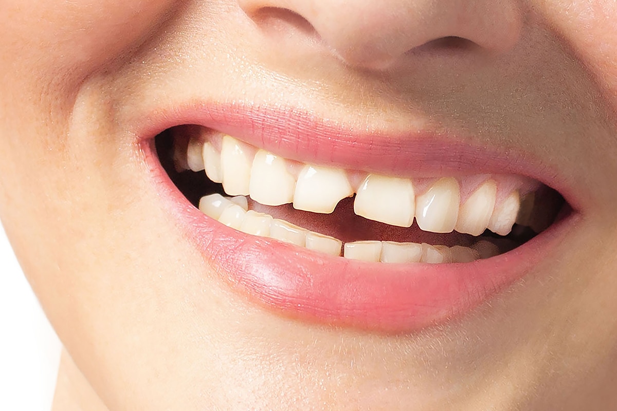 Endodontic Treatment for Tooth Fractures in Young Athletes - Modern ...